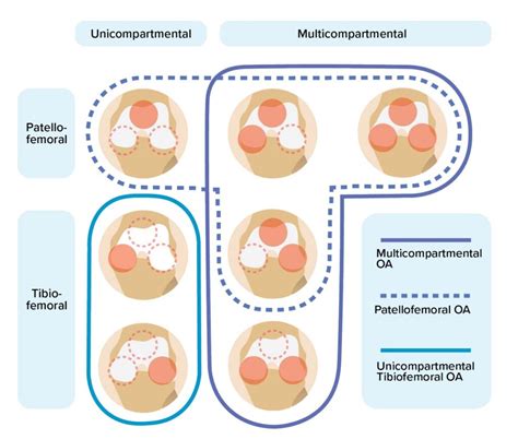 Guide To Severe Knee Arthritis Tricompartmental Osteoarthritis
