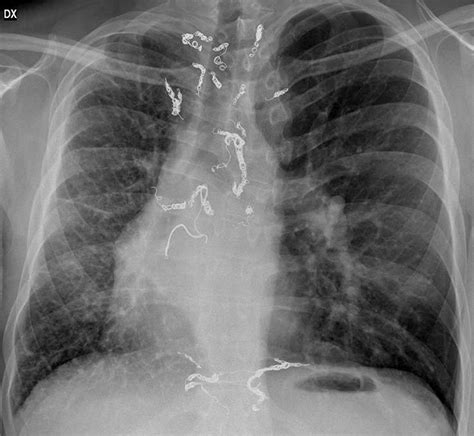 Chest X Ray Showing The Result Of Extensive Embolization Of The