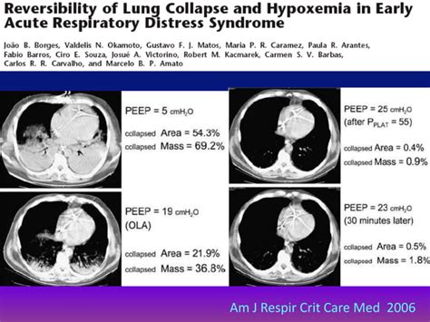 Pv Curve And Lung Recruitment Pptx Lung And Respiratory Health Diseases And Conditions