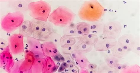 Common Virus Spread Through Sex Can Cause Cancer Many People Arent