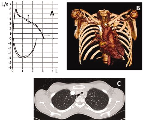 Irreversible Airway Obstruction Due To Innominate Artery Compression Of The Trachea Bmj Case
