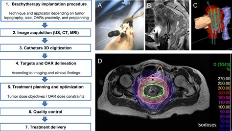 Internal Radiation Therapy Brachytherapy