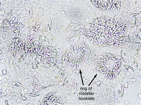 Pathology Outlines Echinococcus