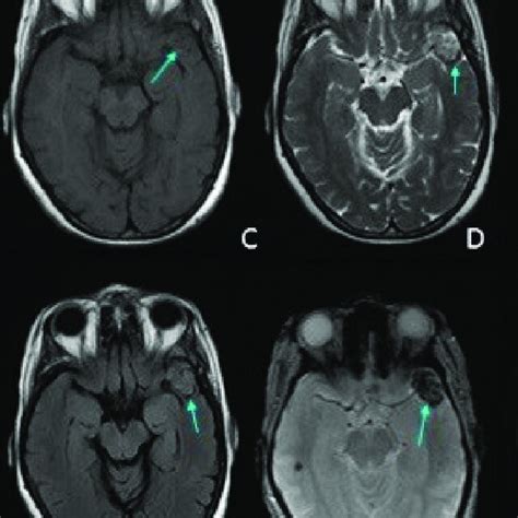 A And B Parenchymal And Bone Windows Of Head Ct Without Contrast Show A Download Scientific