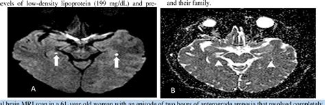 Figure 1 From Transient Global Amnesia With Bilateral Hippocampal Findings In Magnetic Resonance