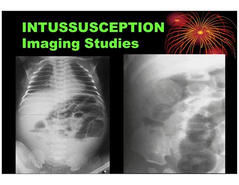 Pediatric Intussusception An Overview
