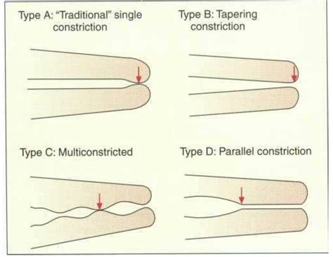 9 Dummers Classifications Of Apical Canal Anatomy Redrawn