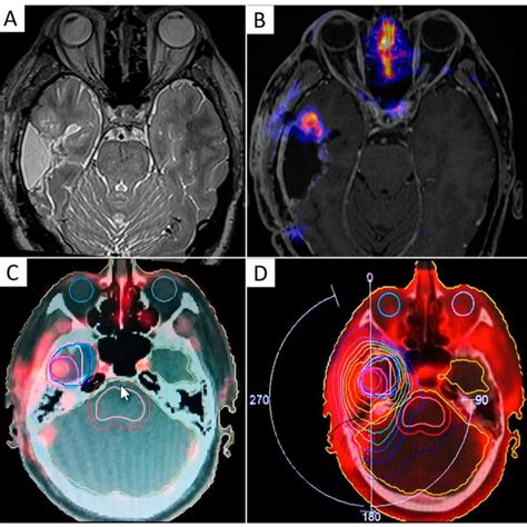 Example Of A Volumetric Modulated Arc Therapy Vmat Sequential Boost Download Scientific