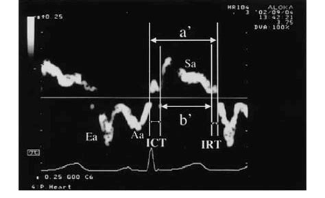 Schematic Drawing Of The Time Intervals Of The Myocardial Performance Download Scientific