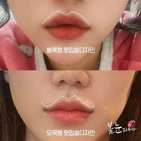 봄눈피우다의원 입술필러 윗입술디자인의 종류💋 ⠀ 윗입술디자인은 볼록형과 오목형 2가지로
