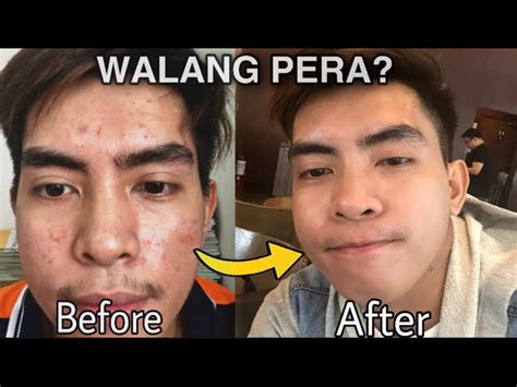 Mabisang Gamot Para Sa Pimple
