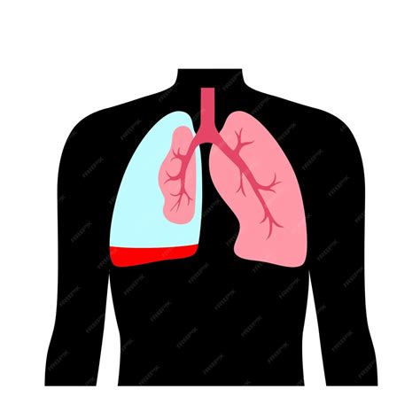 Premium Vector Hemopneumothorax Medical Poster
