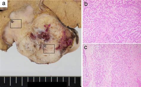 Primary Intrahepatic Cholangiocarcinoma With Sarcomatous Stroma Case