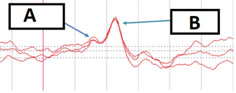 Ecog And Cochlear Microphonic Flashcards Quizlet Ecog And Cochlear Microphonic Flashcards Quizlet