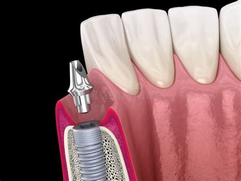 Standard Abutment Stock Illustrations 6 Standard Abutment Stock