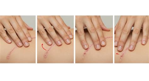 Scar Tissue Massage After Surgery The Ultimate Guide To Recovery And