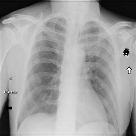 Nih Chestx 14 Object Detection Model V1 2024 11 25 2 55pm By Fares