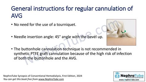 Hemodialysis Chapter 9 Arteriovenous Fistula And Graft Basics