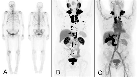 Diffuse Osseous Metastatic Disease Bone Metastases Imaging Practice