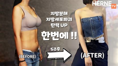 바디인모드fx 바디포인트주사지방파괴주사 울핏을 같이 하면 효과가 최대로 3스텝지방파괴 Youtube