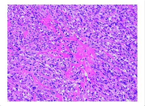 Primary Radiation Induced Soft Tissue Osteosarcoma In 2010 From The Download Scientific