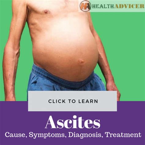What Is Tips Procedure For Ascites At Indiana Townson Blog