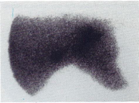 A 99mtc Pertechnetate Thyroid Scan Of A 2 2g Taken With The Window Set Download Scientific