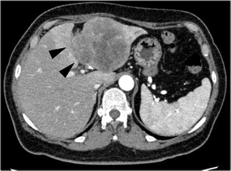Computed Tomography Scan Showed An Intrahepatic Mass Measuring 9 × 9 × Download Scientific