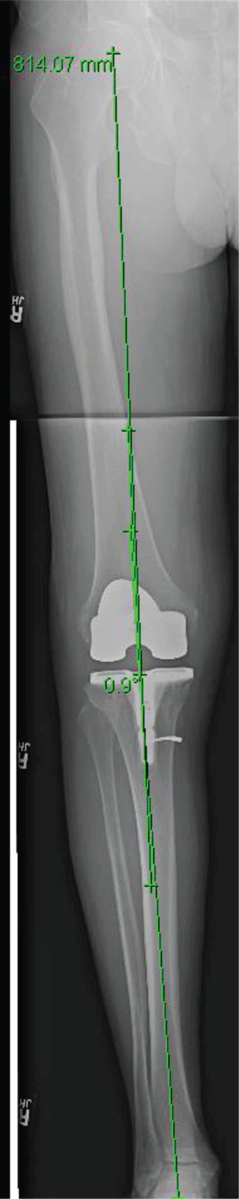 Postoperative Full Leg Standing Radiograph Of The Left Leg For Case 4