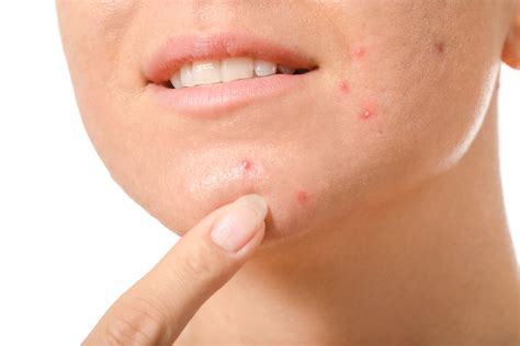 Common Signs On How To Tell If Acne Is Hormonal Or Bacterial 2023