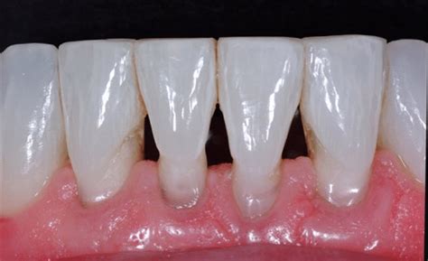 How To Get Rid Of Dental Caries Blog