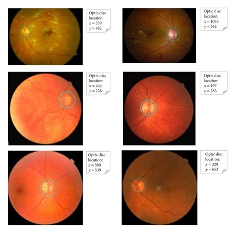 The Results Of The Optic Disc Detection Download Scientific Diagram