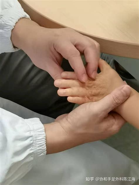 不是所有并指都可以用人工免植皮 知乎
