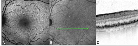 Imaging Of Reticular Pseudodrusen Example Of Reticular Pseudodrusen