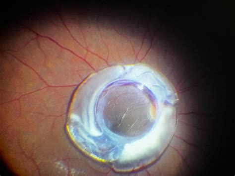 Blog Intraocular Lens Dislocation Prime Retina Eye Care Centre Best Eye Hospital In