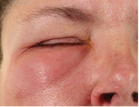 Eye Orbital Cellulitis