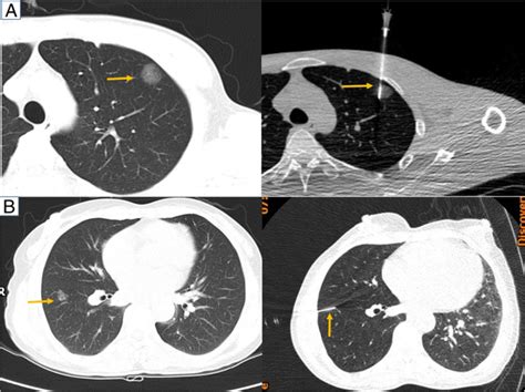 Computed Tomography Guided Preoperative Semi Rigid Hook Wire Localization Of Small Pulmonary