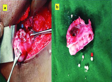 Ruptured Appendicitis