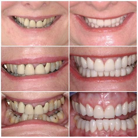 Normal Tooth Bite Overbite Correction How To Fix Overbite Face