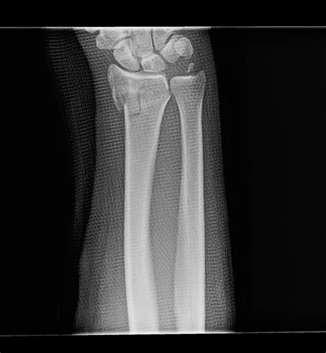 Orthodx Displaced Distal Radius Fracture Clinical Advisor