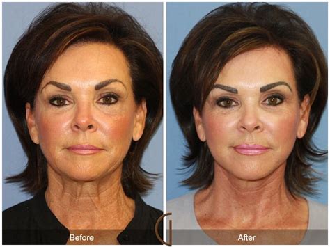 Patient 366348 Facelift 60s Before And After Photos Dr Kevin Sadati