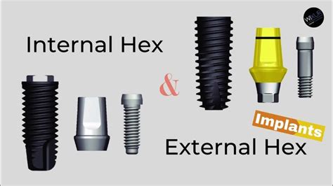 External And Internal Hex Implant Connections Explained Youtube