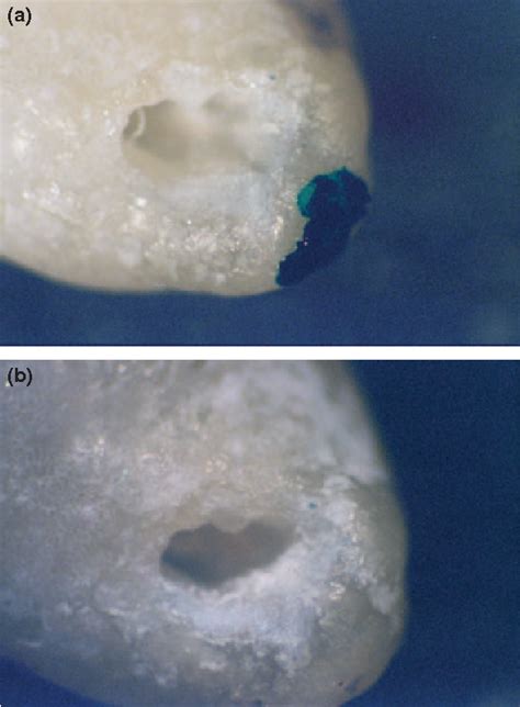 Figure 1 From Apical Transportation Created Using Three Different Patency Instruments