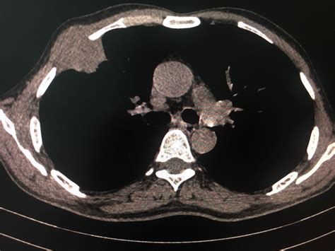 Rib Bone Erosion At Audrey Cunningham Blog