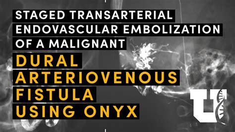 Staged Transarterial Endovascular Embolization Of A Malignant Dural