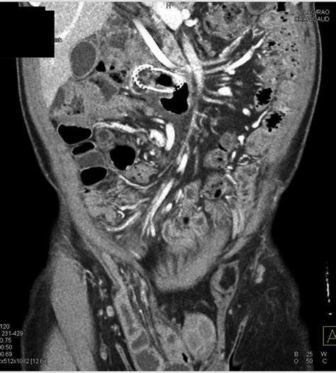 Small Bowel Obstruction Sbo Due To Hernia Of Small Bowel Through