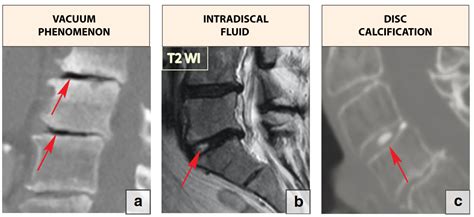 Radiology Vibes Signs Of Intervertebral Disc Facebook
