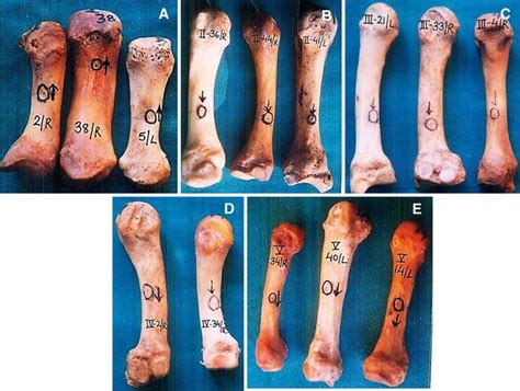 Situation Of Nutrient Foramens In Relation To Circumference Of Shaft Of