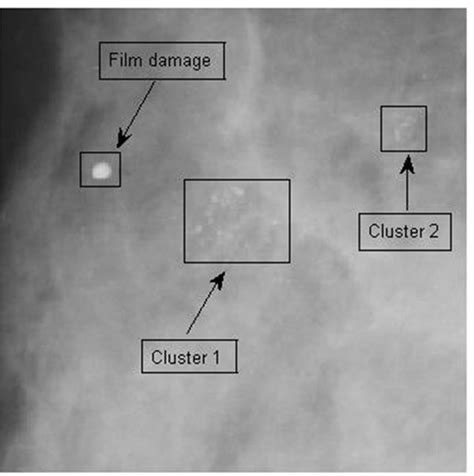 On Wavelet Transform General Modulus Maxima Metric For Singularity Classification In Mammograms