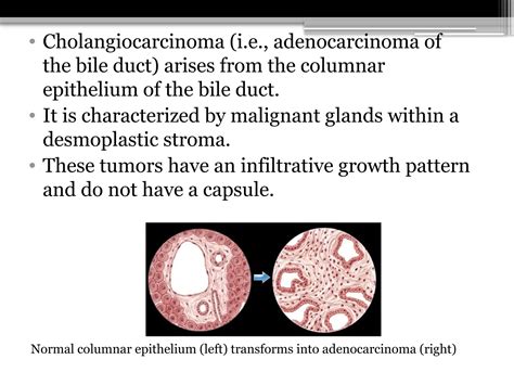 Cholangiocarcinoma Sudhan Radiological Imaging Ppt